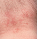 Birthmarks | Pregnancy and Parenting